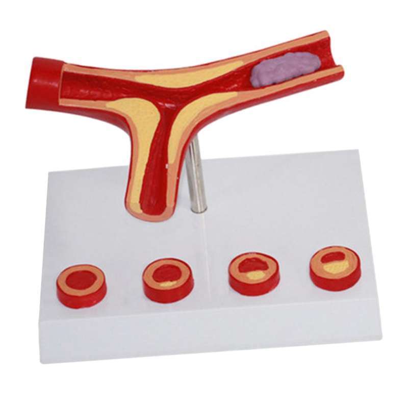 Jual Human Vessel Anatomical Atherosclerosis Model for Science Learning ...