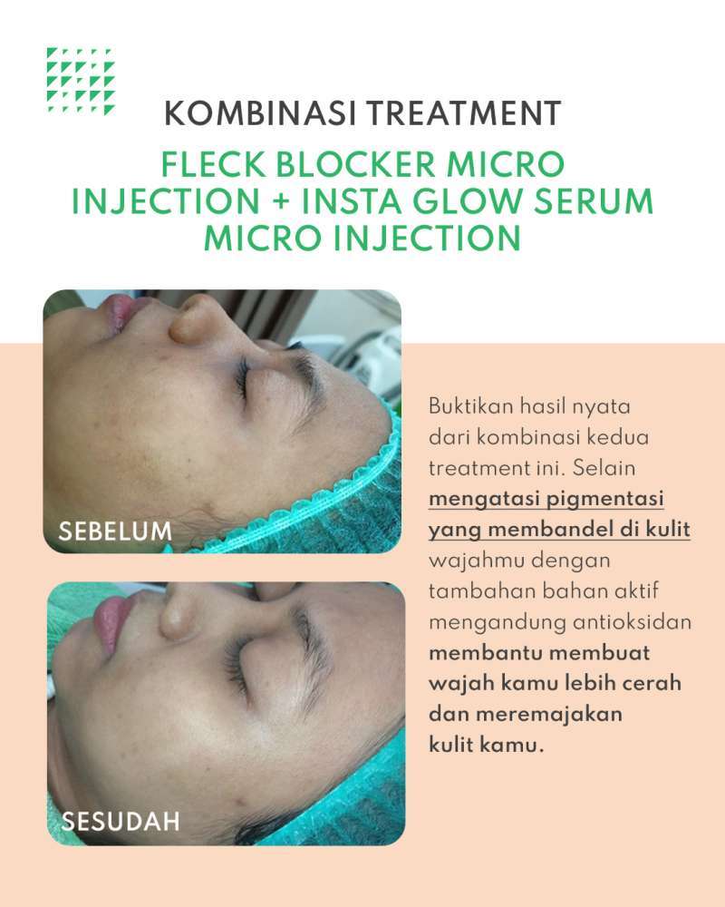 Jual Zap Clinic Insta Glow Serum Meso Injection Di Seller Zap Clinic ...