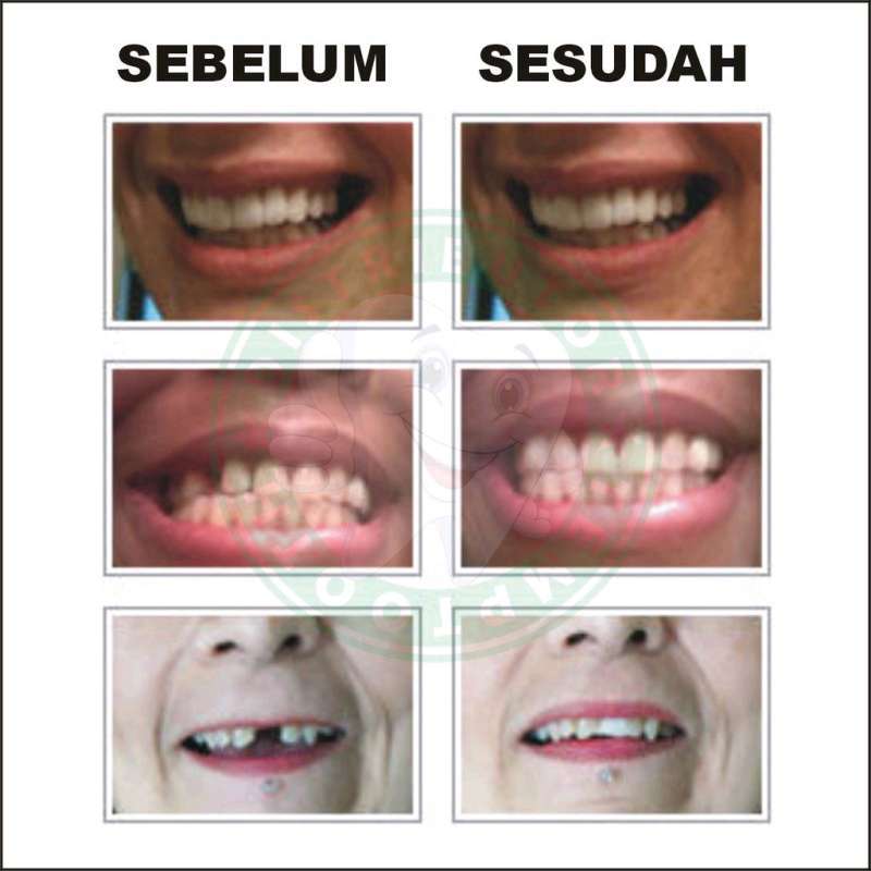 Jual TAMBAL GIGI OMPONG RENGGANG DAN PATAH PRAKTIS MANDIRI di Seller ...