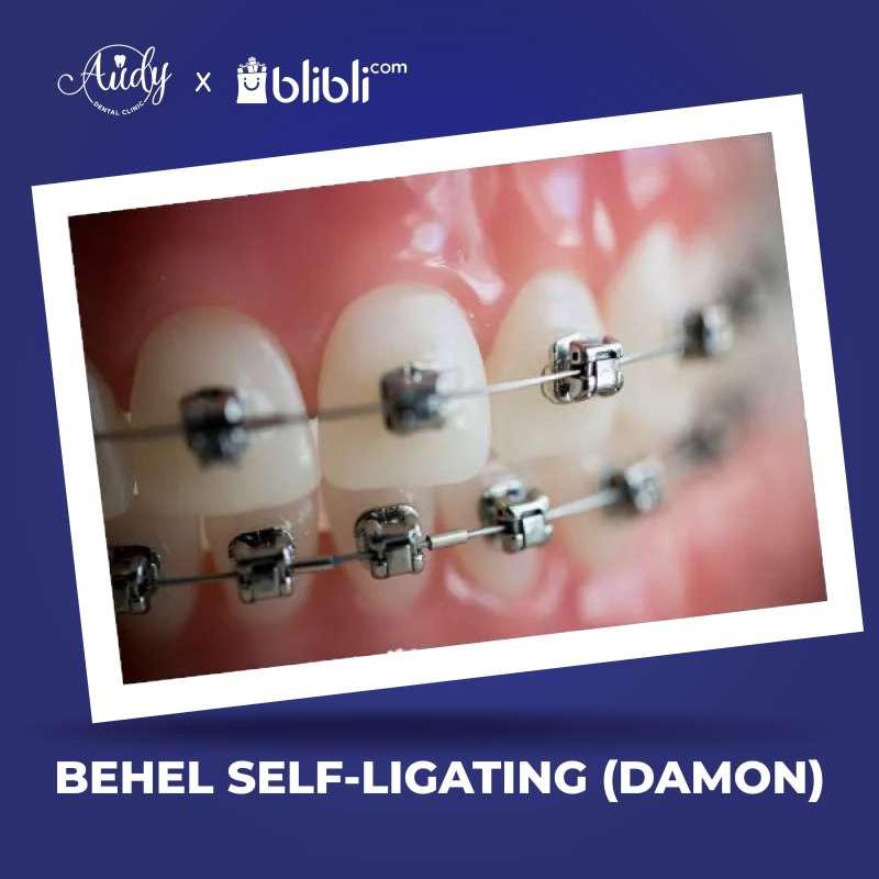 Jual Behel Self Ligating Damon Metal Di Seller Audy Dental Bogor ...