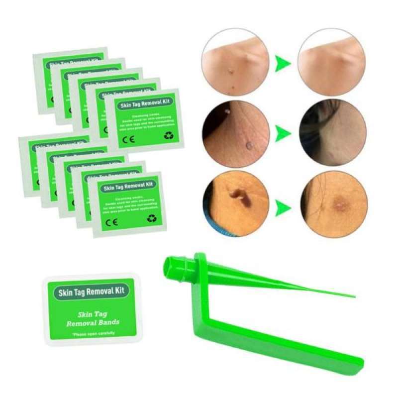 Jual Skin Tag Remover Device Kit Fast & Effective Skin Tags Removal ...