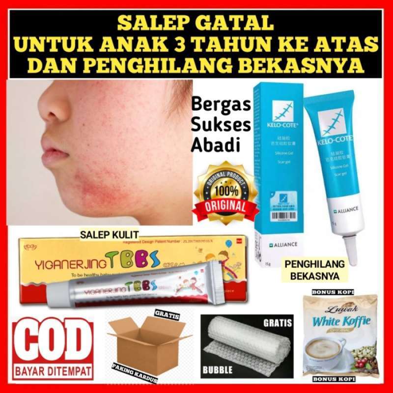 Jual Salep Gatal Untuk Anak 3 Tahun Ke Atas & Penghilang Bekasnya Di ...