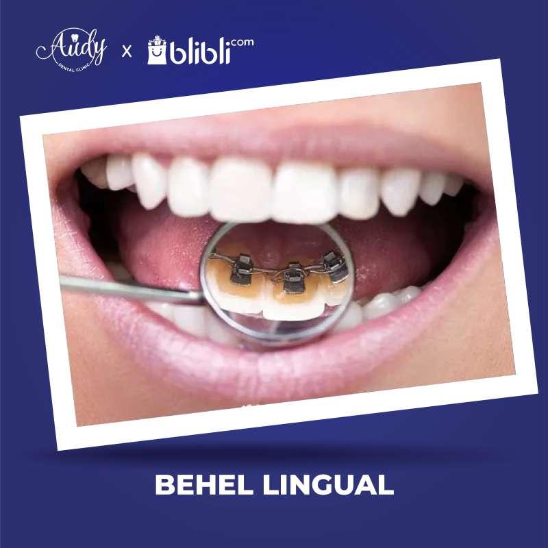 Jual Behel Lingual Mini Clippy Voucher Di Seller Audy Dental Cinere ...