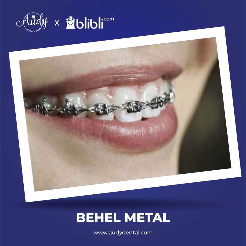 Jual Voucher Behel Metal Ortho Classic di Seller Audy Dental Bandung ...