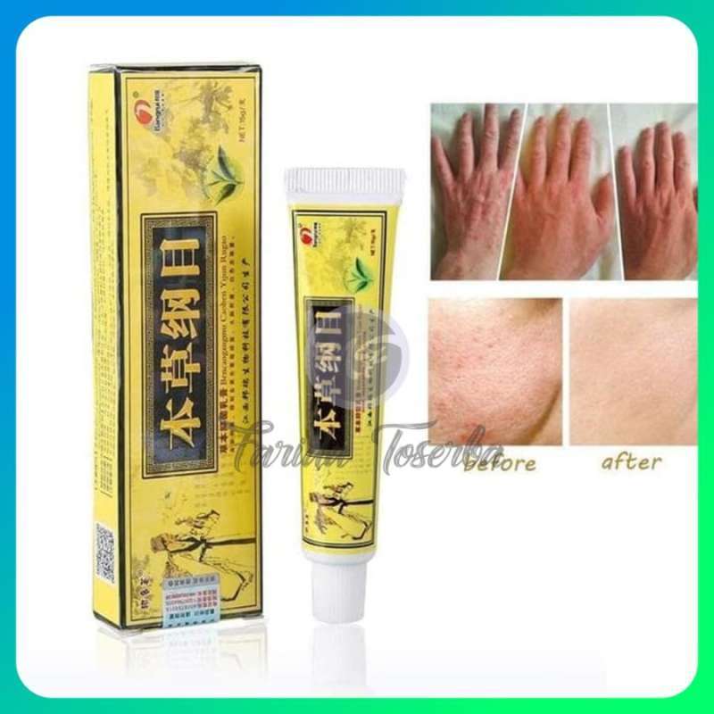 Jual ORIGINAL Salep Herbal Untuk Psoriasis Dermatitis Dan Eczema di ...