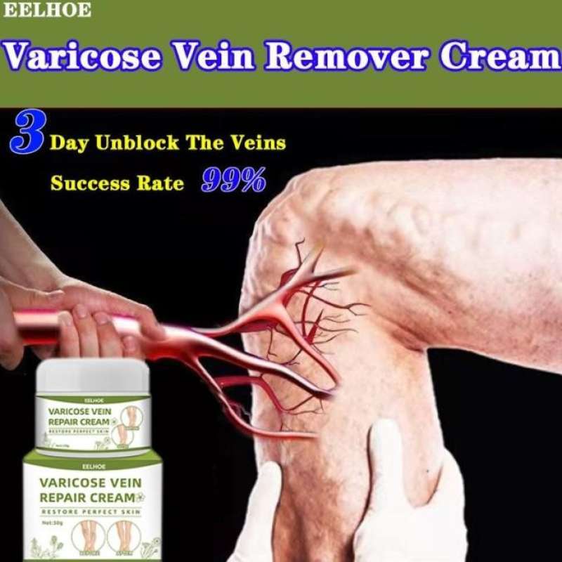 Perawatan Varises - Perumperindo.co.id