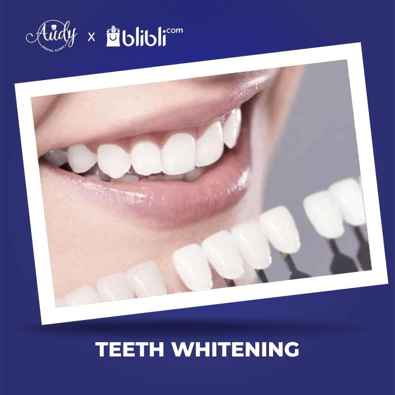 Promo Advanced Bleaching (Teeth Whitening) Diskon 38% di Seller Audy ...