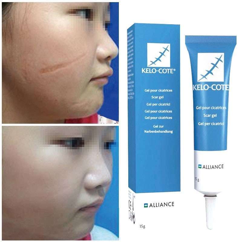 Jual Kelo Cote Gel Obat Bekas Luka Operasi Keloid [15 g] di Seller CV ...