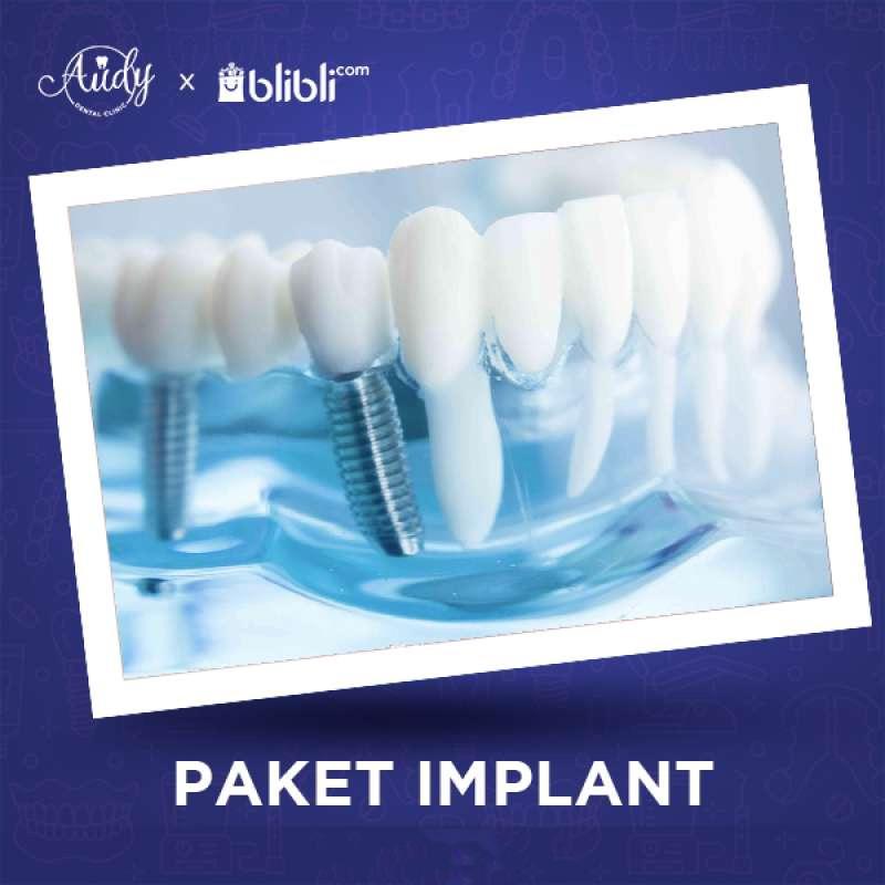 Jual Audy Dental Clinic Pantai Indah Kapuk Paket Implan Gigi Voucher ...