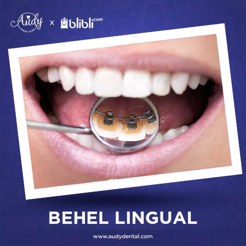 Jual Voucher Behel Mini Clippy Lingual Audy Dental Kuningan di Seller ...