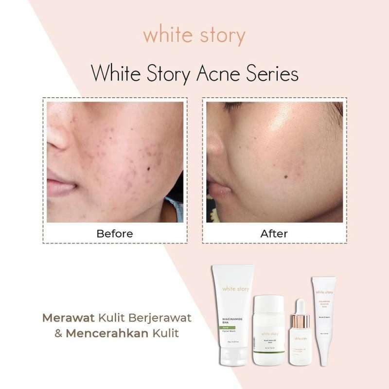 Jual White Story Paket Acne Lengkap di Seller White Story Store - Ancol ...