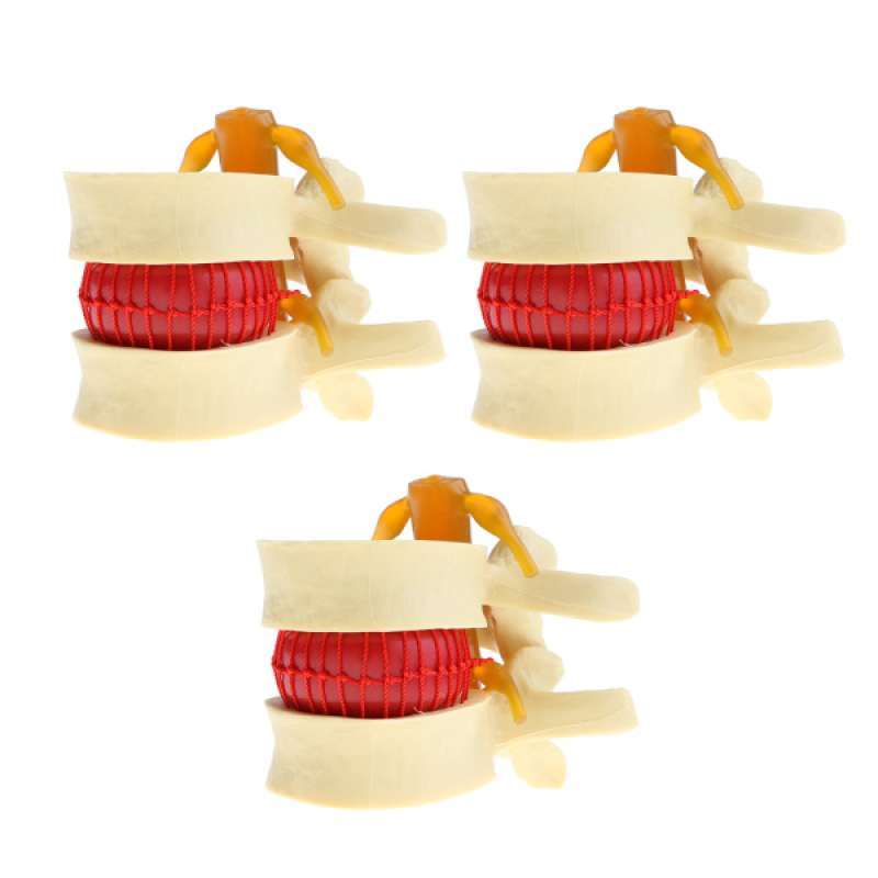 Jual 3PCS Professional Human Lumbar Intervertebral Disc Protrusion Lab ...