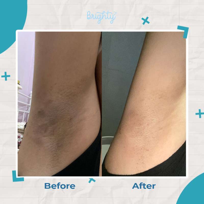 Promo [glowing Package] Brighty Glowing Underarm 3 Pcs Diskon 30% Di ...