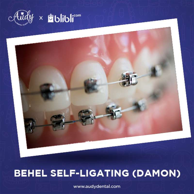 Jual Voucher Behel Self Ligating Empower - Clippy Metal Audy Dental ...