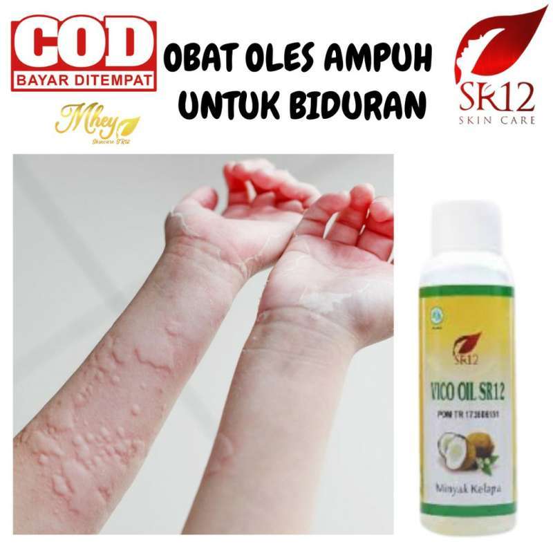 Jual OBAT ALERGI BIDURAN KALIGATA GATAL-GATAL / BIANG KERINGAT/RUAM ...