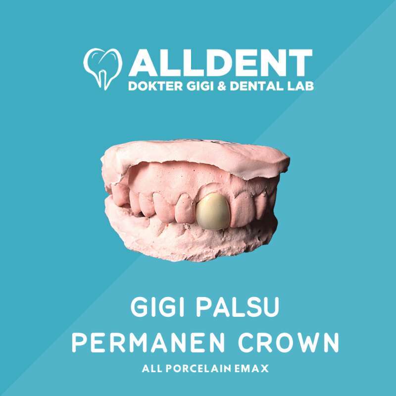 Promo Gigi Palsu Permanen Crown - All Porcelain Emax Diskon 13% di ...