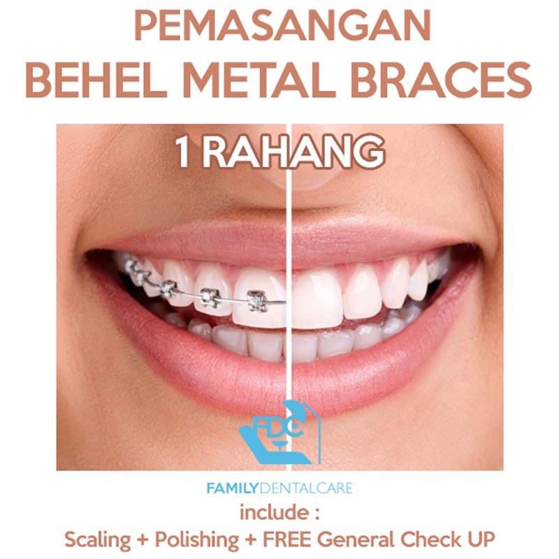 Harga Pasang Behel – newstempo