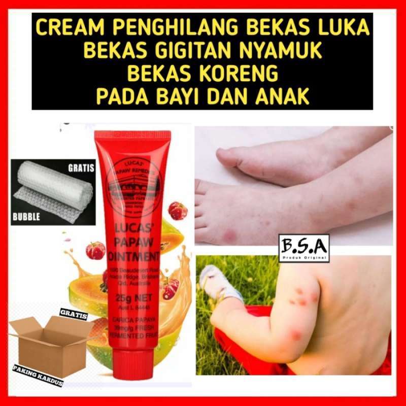 Promo Cream Penghilang Luka Gigitan Nyamuk Pada Bayi Dan Anak Diskon 35 ...
