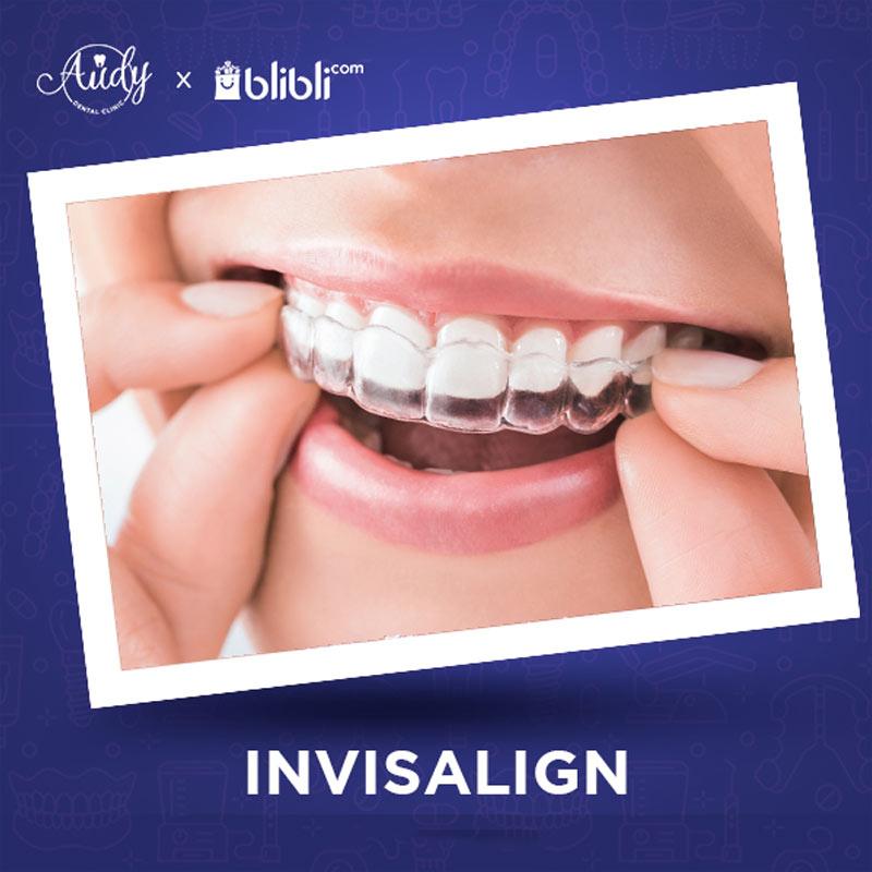 Jual Audy Dental Clinic Invisalign Mild Case Tiket Di Seller Audy ...