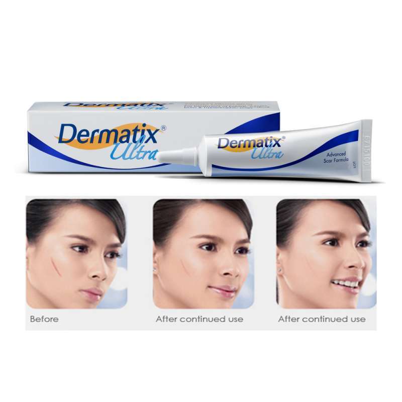 Jual Dermatix Ultra Gel Ukuran 5 Gram di Seller Borong Donk - Binjai ...