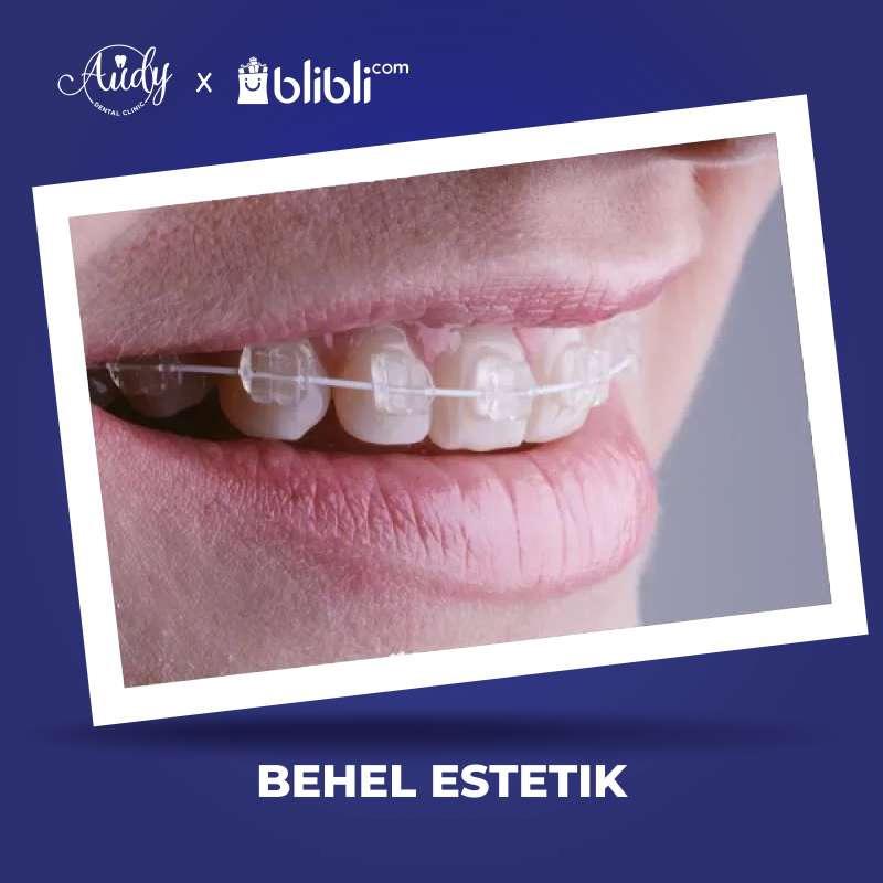 Promo Behel Estetik Fix Ceramic Gemini Diskon 12% di Seller Audy Dental ...