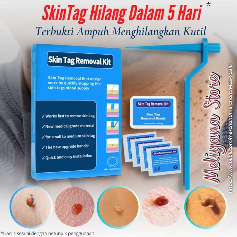 Mole Wart Remover Lengkap Harga Terbaru April 2024 | Blibli