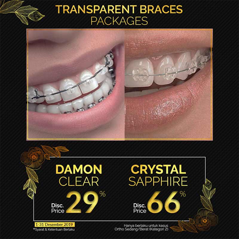 Damon Clear Braces