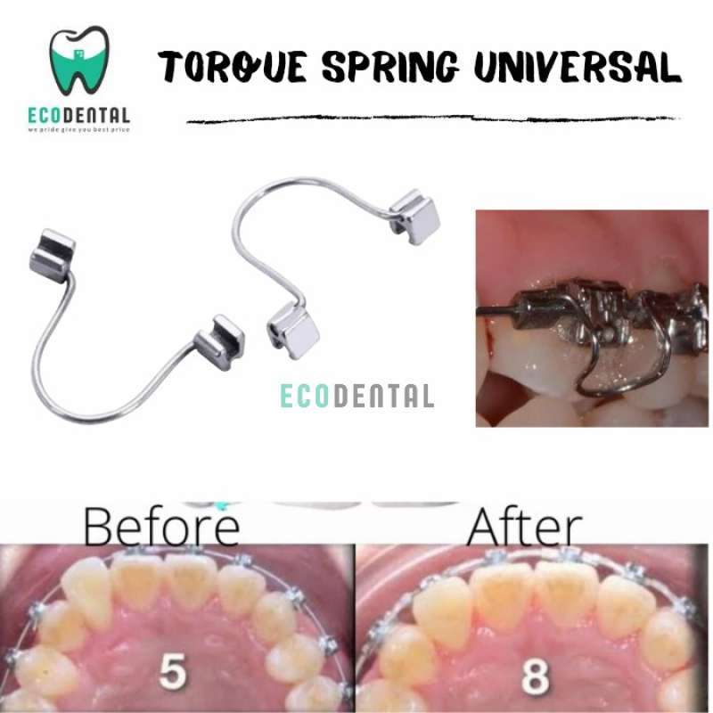 Promo Dental Torque Spring Universal Labial Lingual Root Torquing Ortho Diskon 23% di Seller ...