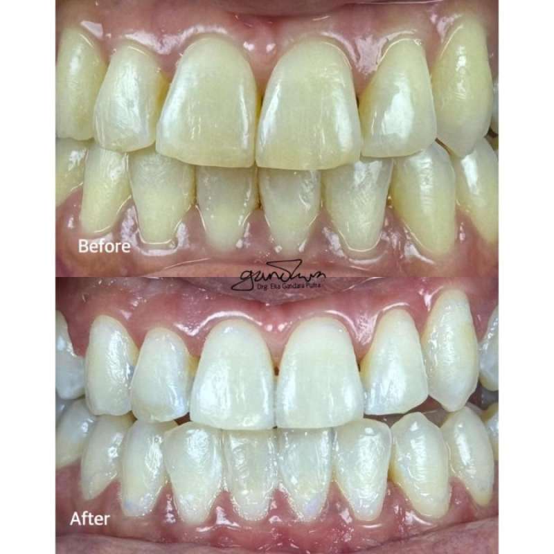 Jual Bahan Bleaching Gigi Dsp White Blue Kit 35% Whitening Tanpa Sinar ...