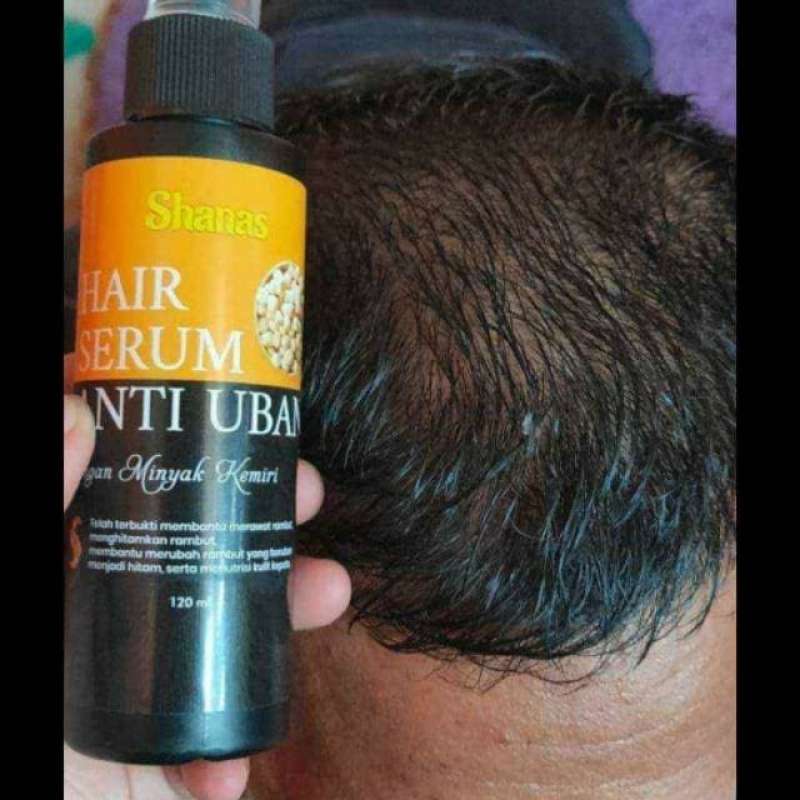 Jual Serum Anti Uban Produk Nasa | Shanas Hair Serum Anti Uban Ori Nasa ...