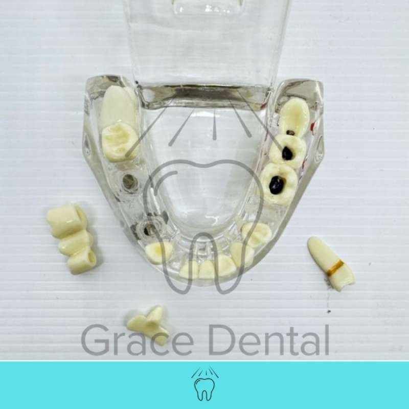 Promo Model Gigi Penyakit Lengkap Karies Endo Exo Bridge Implant ...