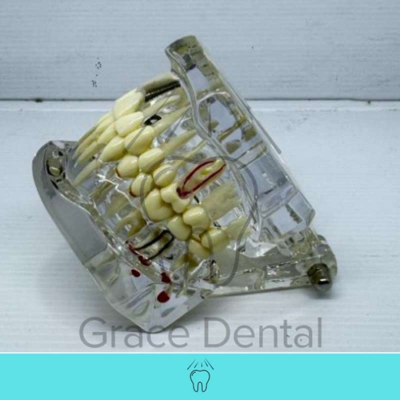 Promo Model Gigi Penyakit Lengkap Karies Endo Exo Bridge Implant ...
