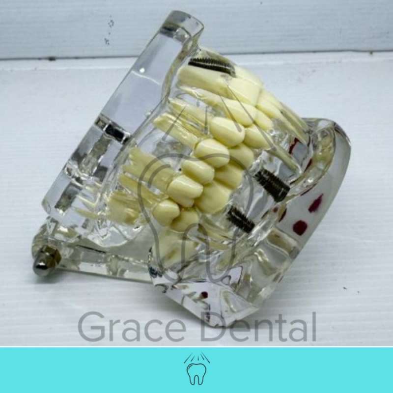 Promo Model Gigi Penyakit Lengkap Karies Endo Exo Bridge Implant ...