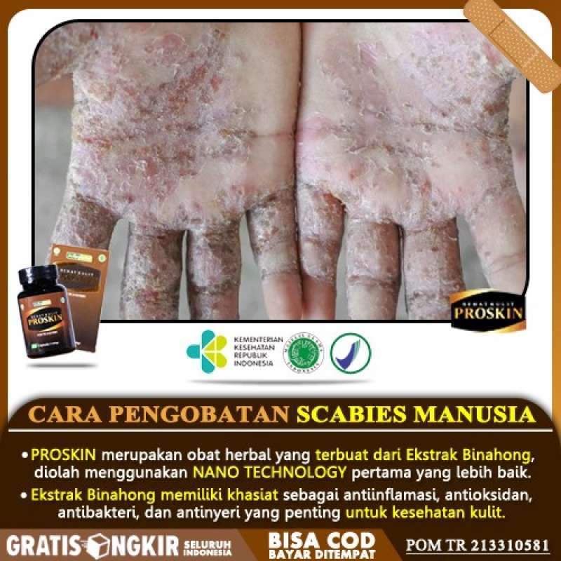 Promo Obat Scabies Manusia Alami Cenang Budug Borok Di Kepala Dengan ...