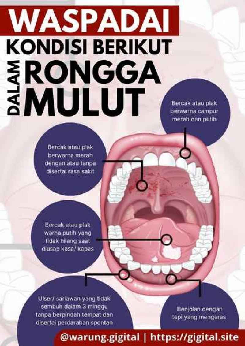 Jual Poster Edukasi: Waspadai Kondisi Kanker Rongga Mulut Di Seller ...