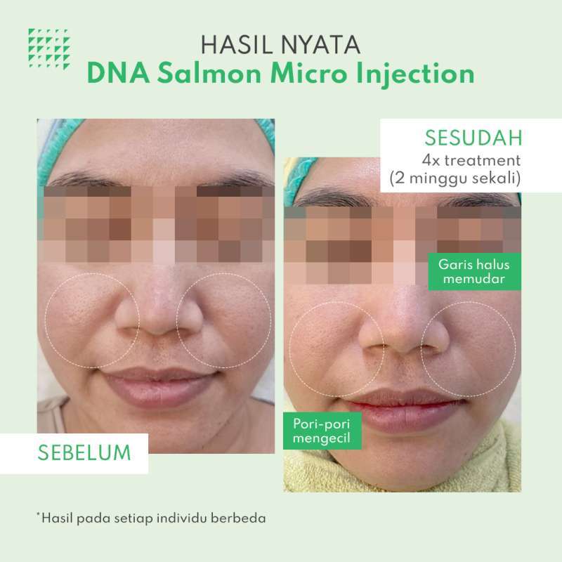 Promo 1 Year Membership Dna Salmon 2.0 Micro Injection Diskon 31% Di ...