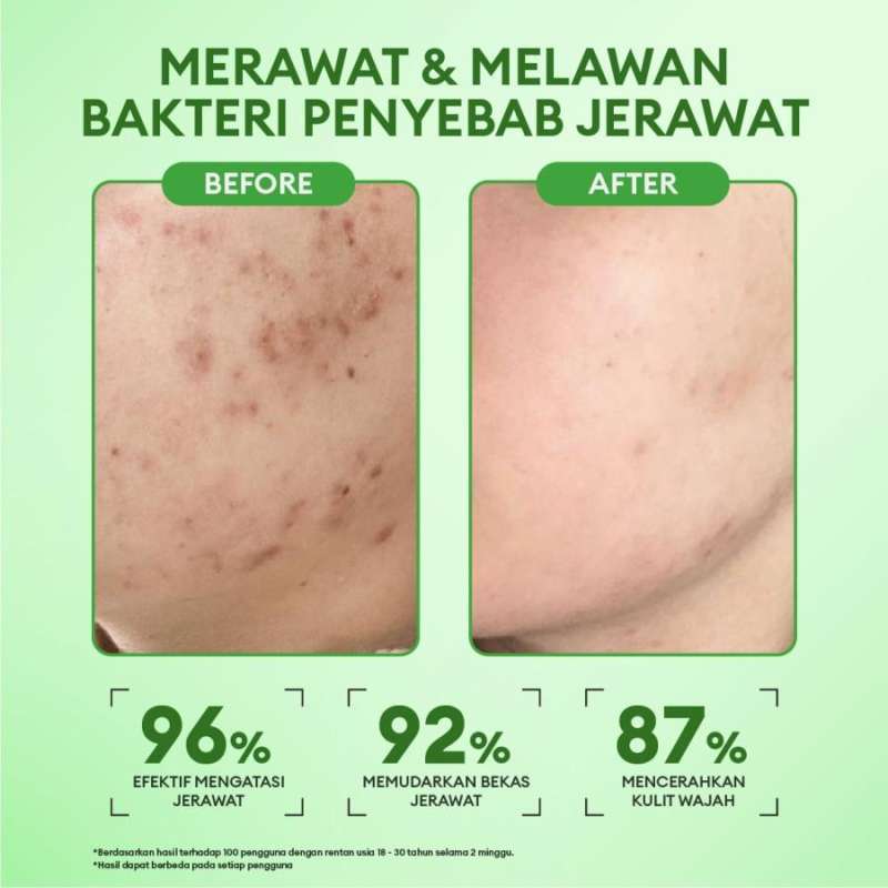 Promo Animate Intense Acne Solution Night Cream 10 Gr Diskon 48% Di ...