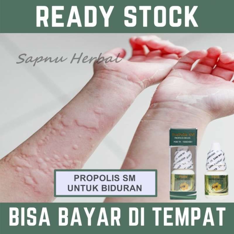 Promo Obat Biduran, Alergi Dingin, Kaligata, Kulit Gatal-gatal, Bentol ...