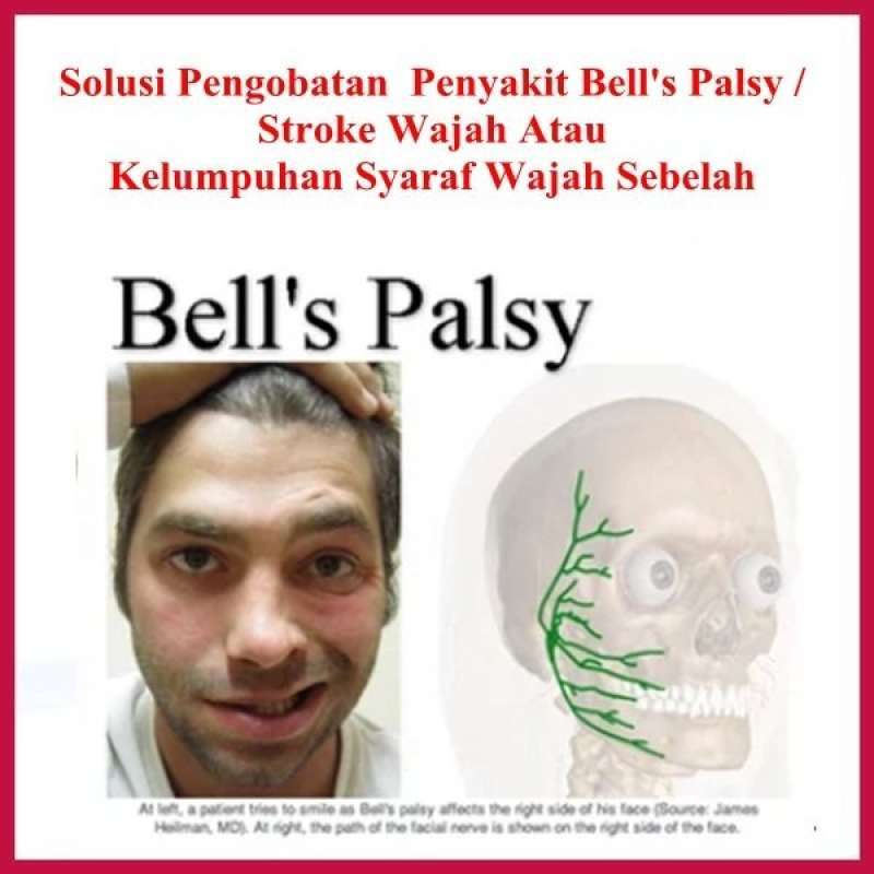 Jual Obat Bell's Palsy Bell Palsy Belpalsi Stroke Wajah Kelumpuhan Di ...