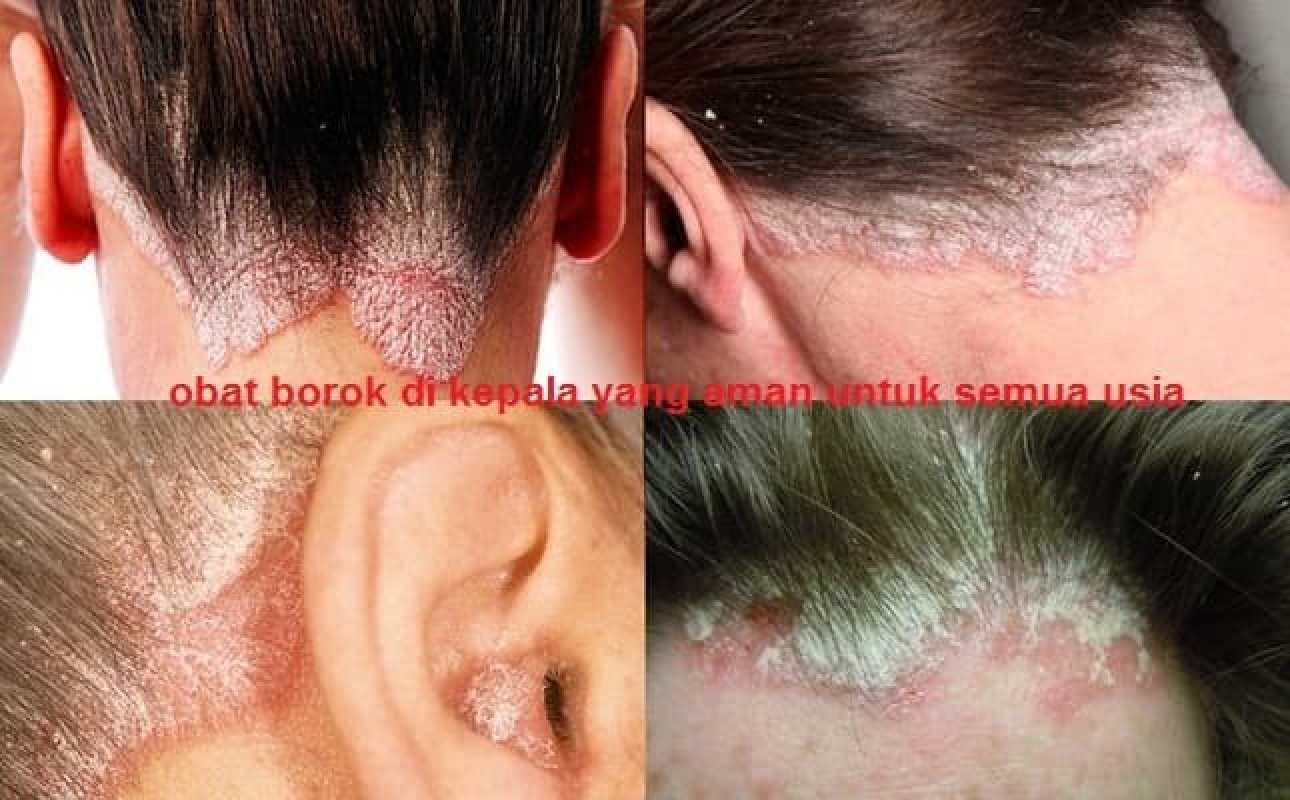 Promo Obat Dermatitis Seboroik,dermatitis Atopik,tinea Capitis ...