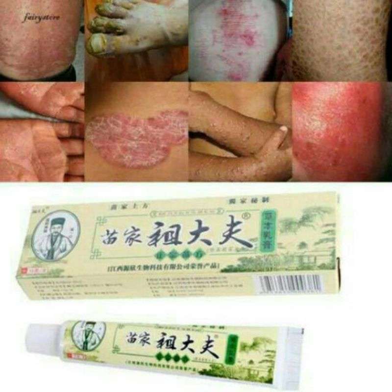 Obat Gatal Ruam Cina Lengkap Harga Terbaru April 2024 | Blibli