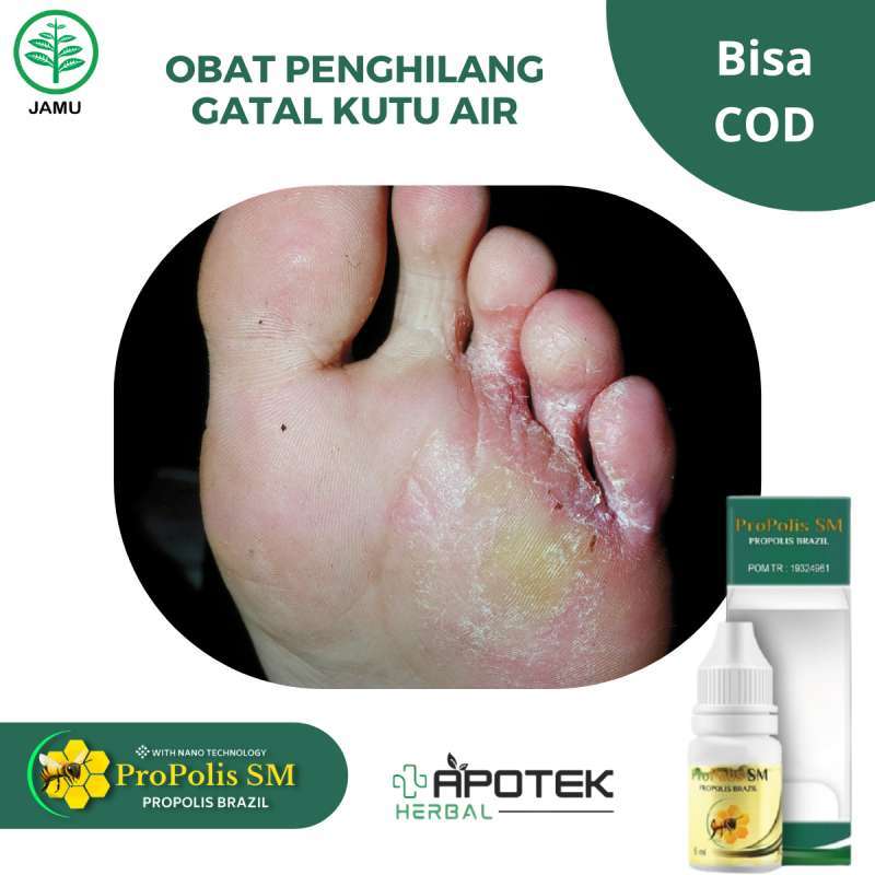 Jual Obat Kutu Air Untuk Kaki Tinea Pedis Jamur Kaki Rangen Kaki Gatal Sela Jari Jari Kaki