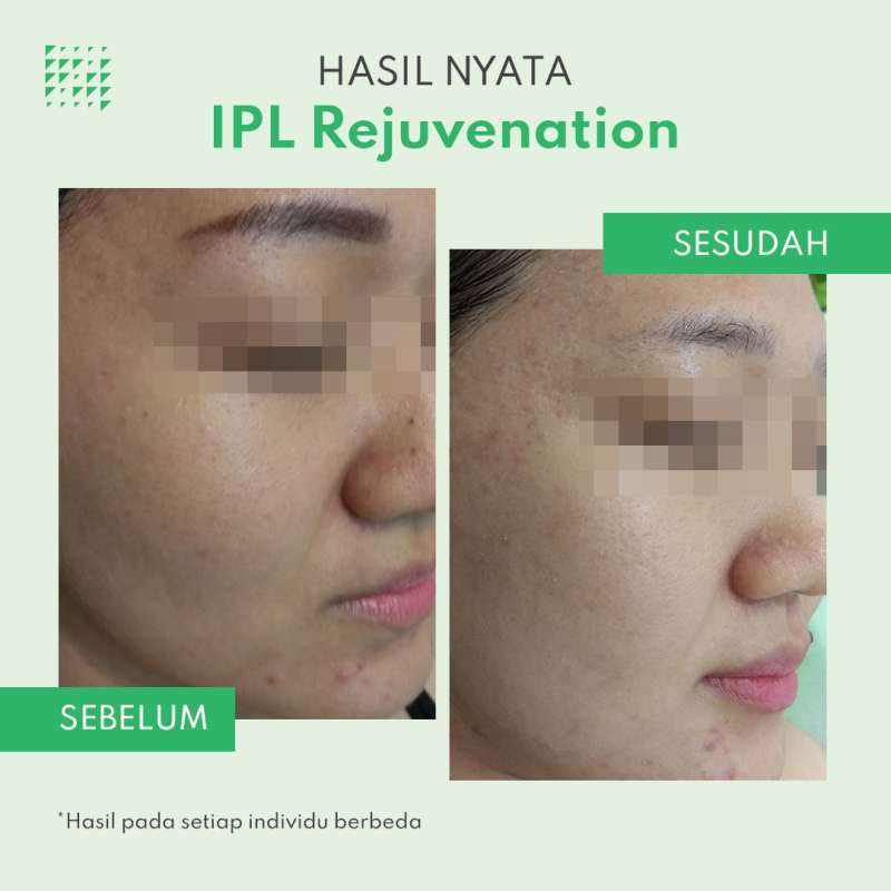 Promo Voucher Spesial 2x Treatment Ipl Rejuvenation Lokasi Baru ...