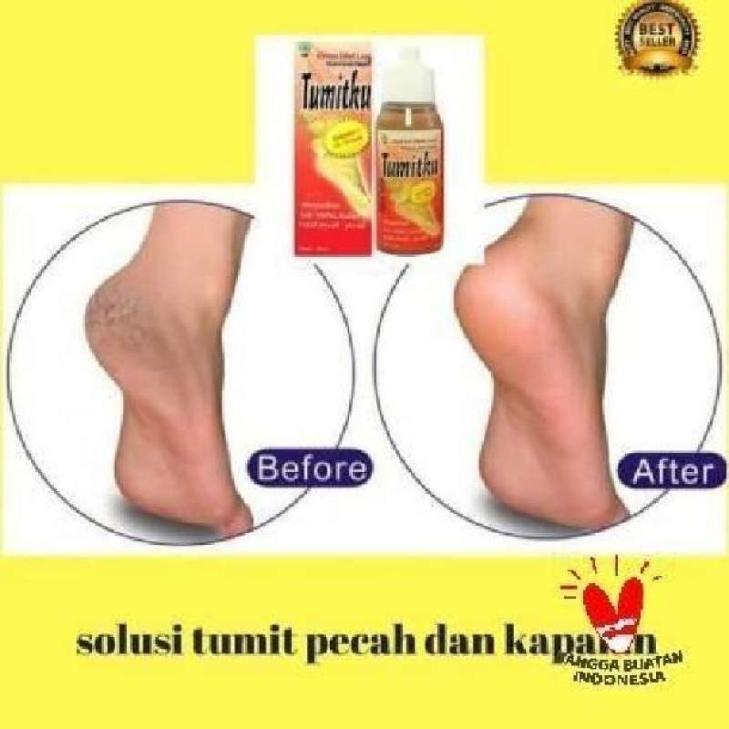 Jual Tumitku Obat Kaki Pecah Original Bpom Kaki Pecah Kapalan Di Seller ...