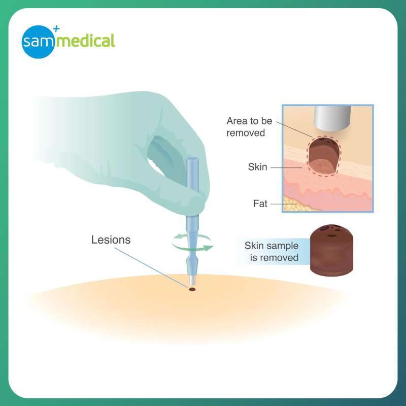 Jual Medax Efitheasy Biopsy Punch / Disposable Biopsi - Satuan ...
