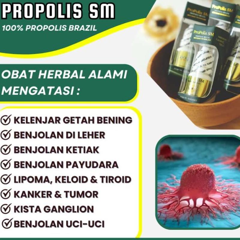Jual Propolis SM Obat Kelenjar Getah Bening, Obat Bengkak Di Leher ...