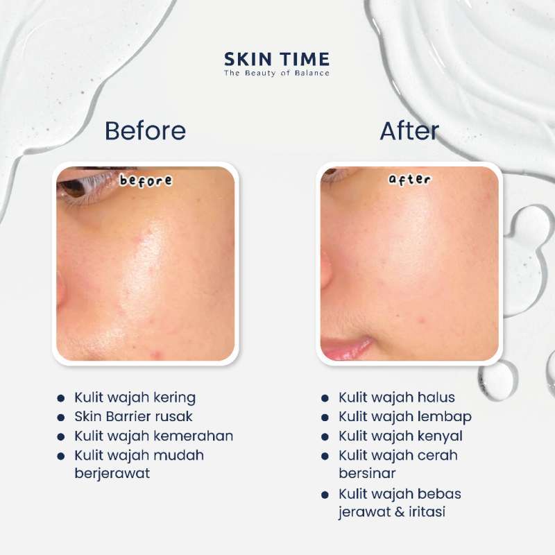 Promo [upgraded 18% Probiotics] Skin Time Probiotic Rebalance Treatment ...