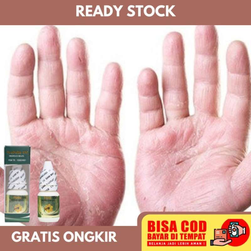 Jual Obat Telapak Tangan Bersisik, Pecah Pecah, Mengelupas, Gatal Di ...