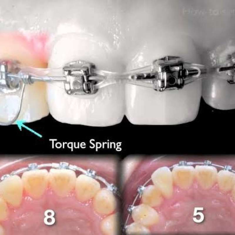 Promo Dental Torque Spring Universal Labial Lingual Root Torquing Ortho Diskon 33% Di Seller ...