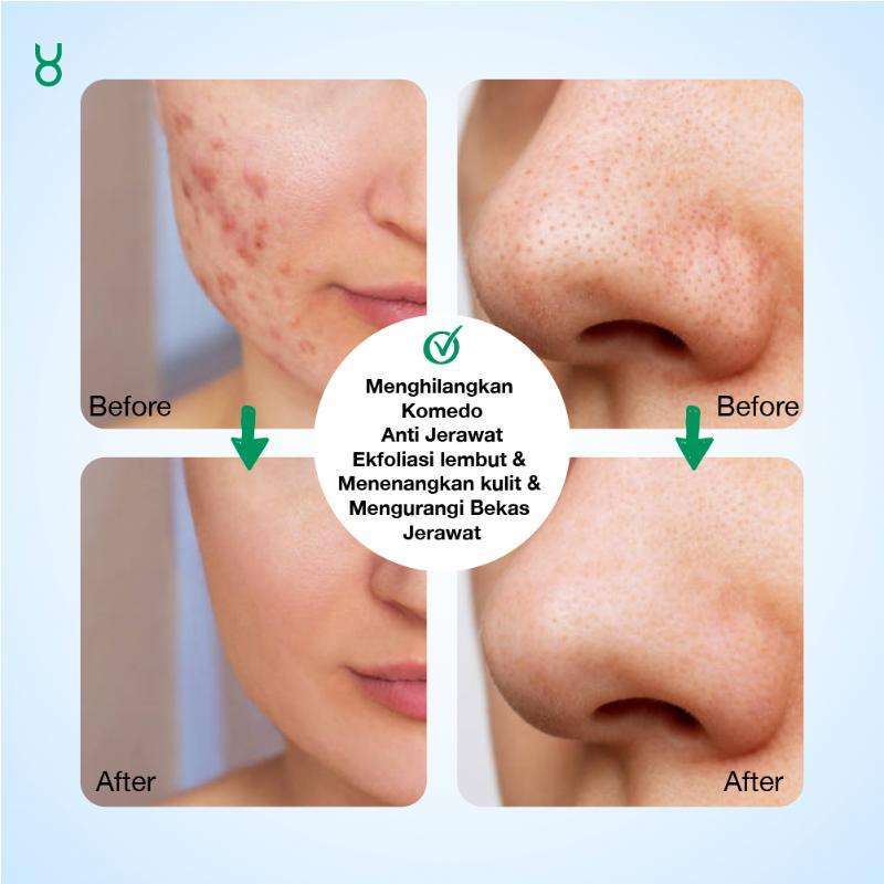 Jual Focalskin Acne Exfoliating Clear Pad 60 Pads / Kapas Eksfoliasi ...